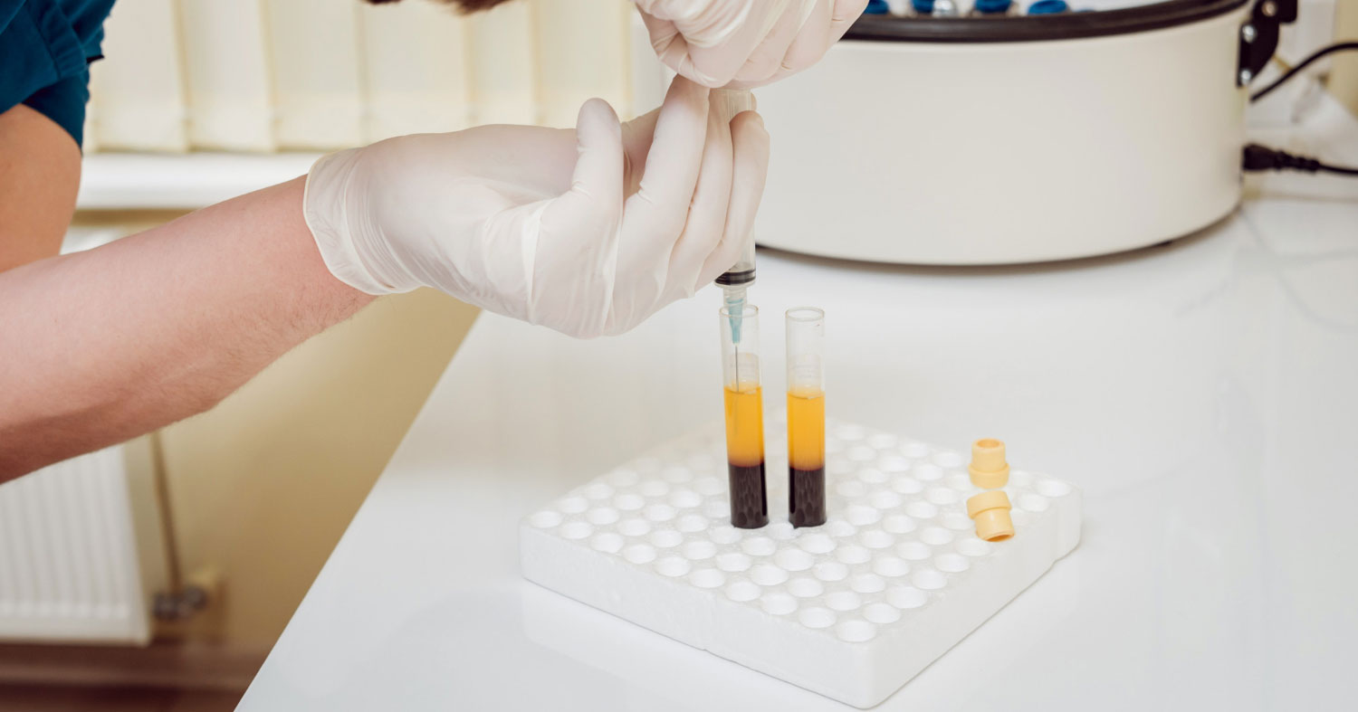 PRP (Platelet Rich Plasma) - Θεσσαλονίκη - Strevinas Plastic Surgery